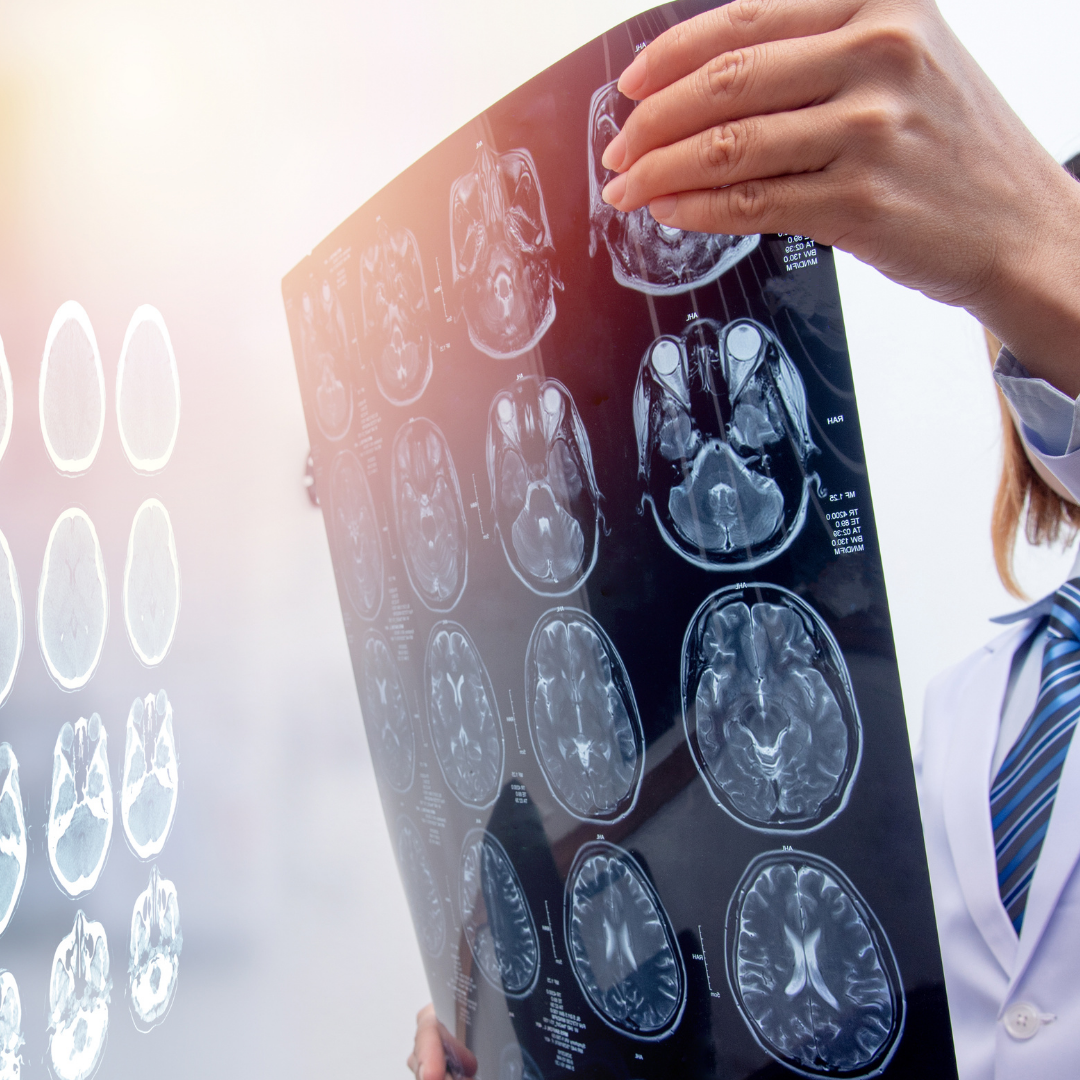 adhd scan | Saving Your Brain